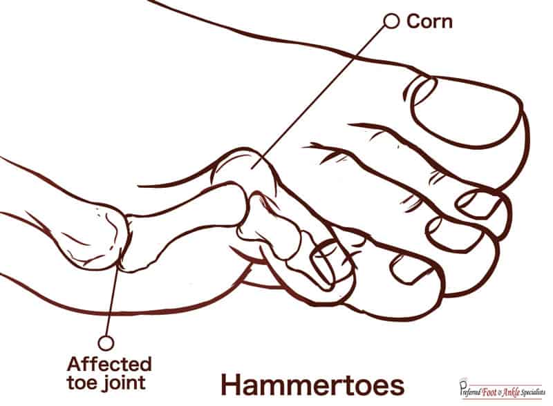 hammer toe symptoms