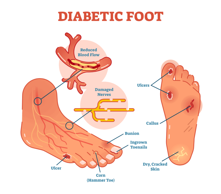 Diabetic Foot Care Tips - Preferred Foot & Ankle