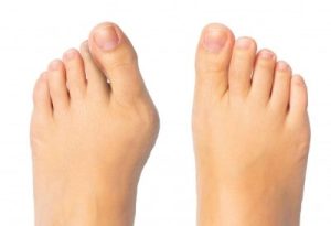 Bunion Removal Surgery | Preferred Foot & Ankle Specialists