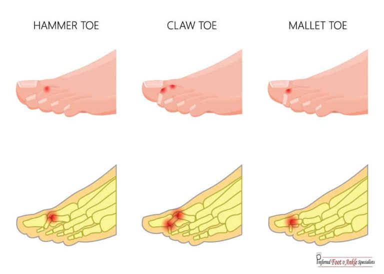 Hammertoe Treatment & Surgery | Preferred Foot & Ankle Specialists